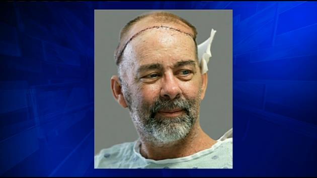 US doctors perform world’s first skull-scalp transplant - WSVN 7News ...