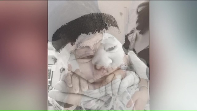 Baby born without part of skull survives - WSVN 7News | Miami News ...