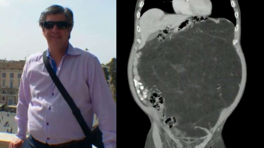 ‘I Dodged A Couple Of Bullets:’ Doctors Shocked To Find 30-Pound Tumor ...