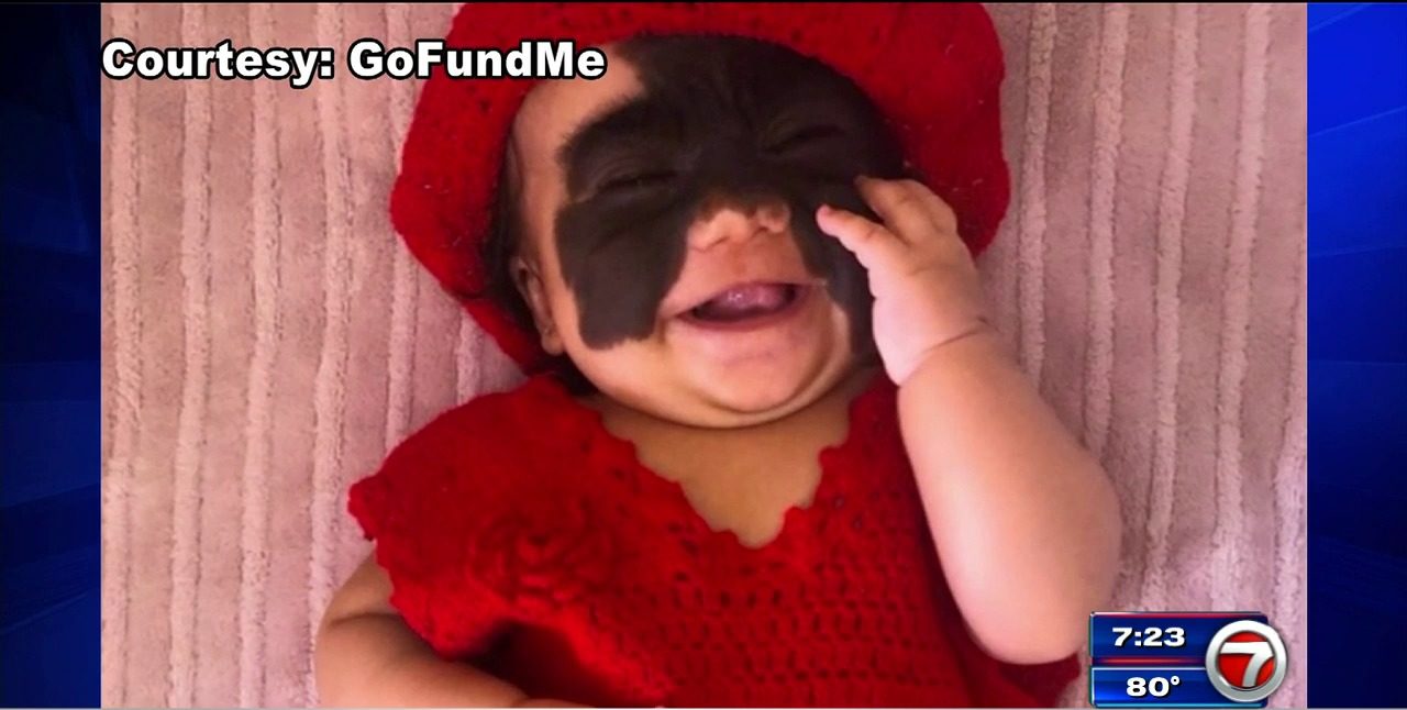 Pompano Beach baby will undergo surgery to remove rare skin condition ...