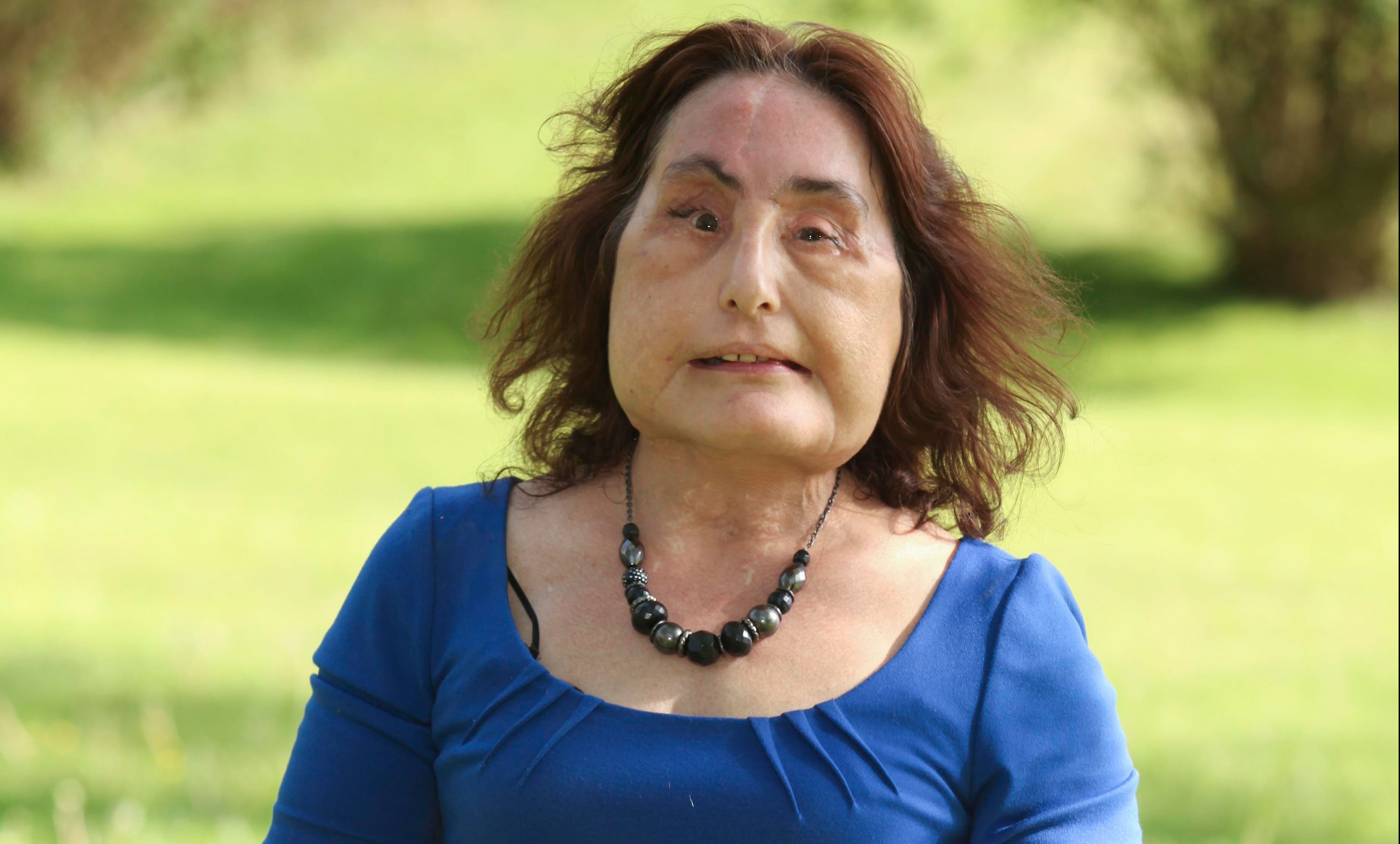 Connie Culp, the first person to receive a near-total face transplant ...