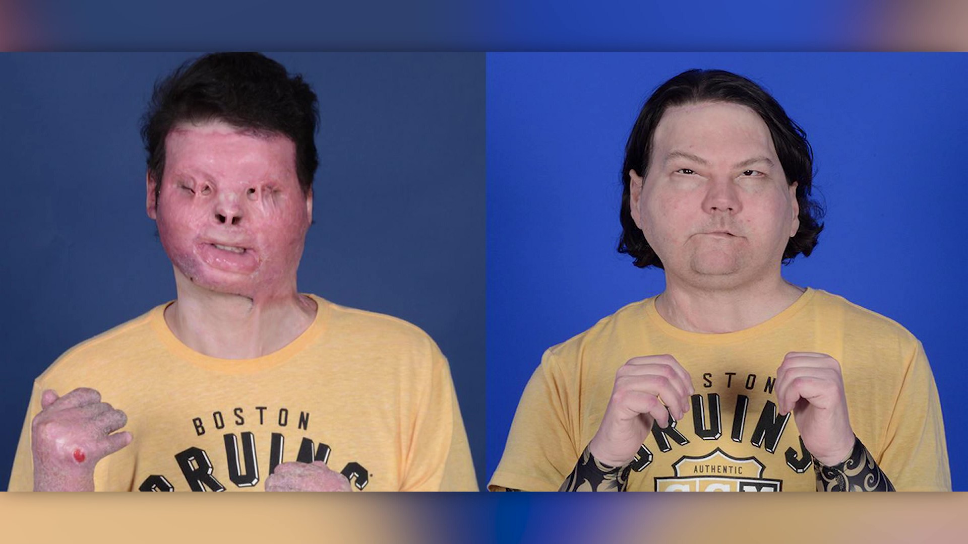 ‘New chance at life’: Man gets face, hands in rare surgery - WSVN 7News ...
