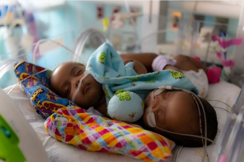 Conjoined Twins After Separation Before And After