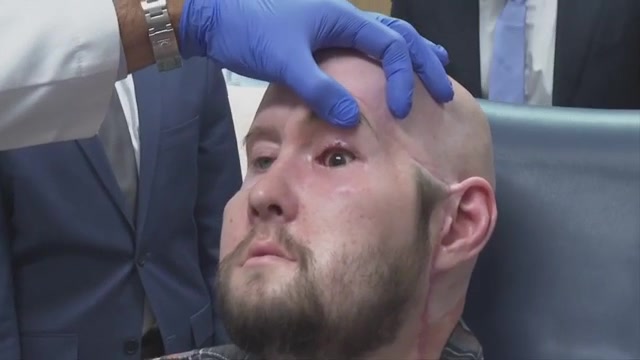 World’s first whole-eye and partial face transplant gives Arkansas man ...