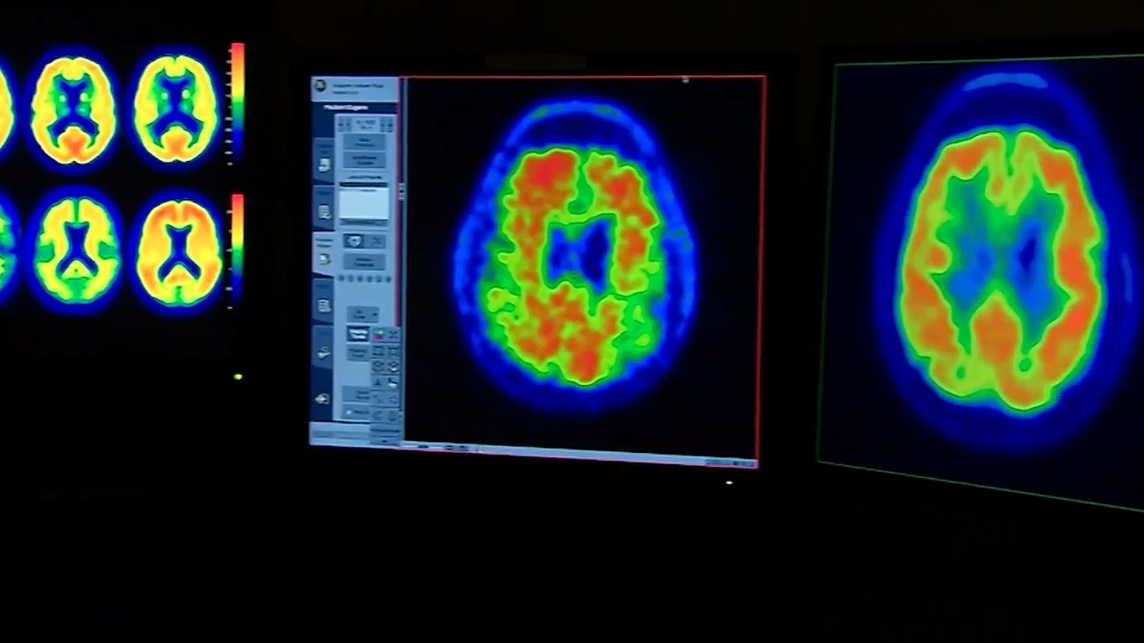 New blood test that screens for Alzheimer’s may be a step closer to ...