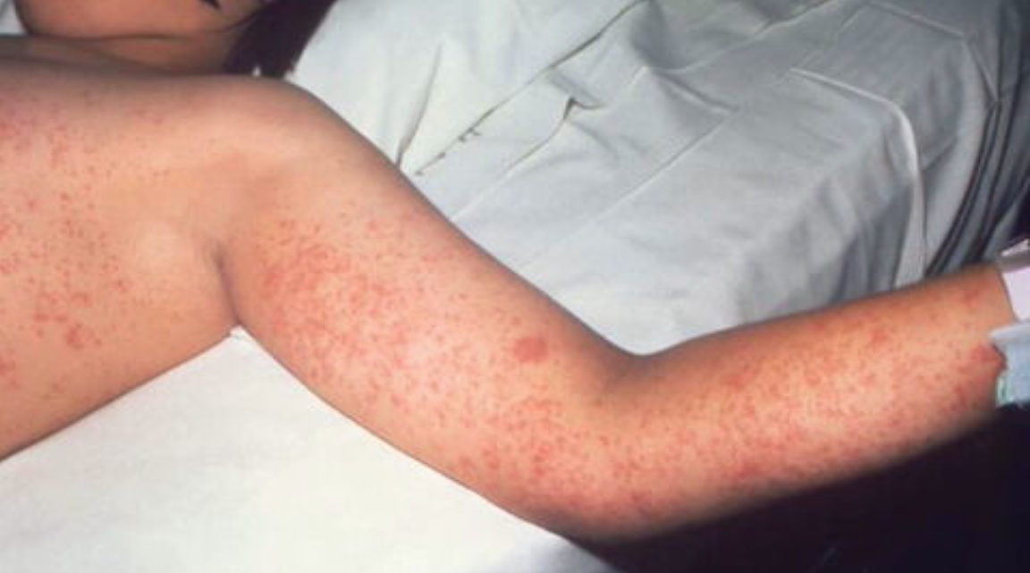 Measles outbreaks rise to nearly 100 cases between Texas and New Mexico ...