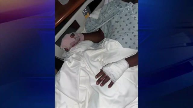 23-year-old loses index finger after firework blows up in his hands in ...